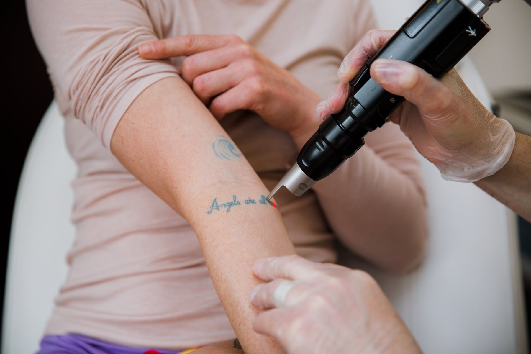 Can Tattoos Be Removed? - Zapp Laser Studio